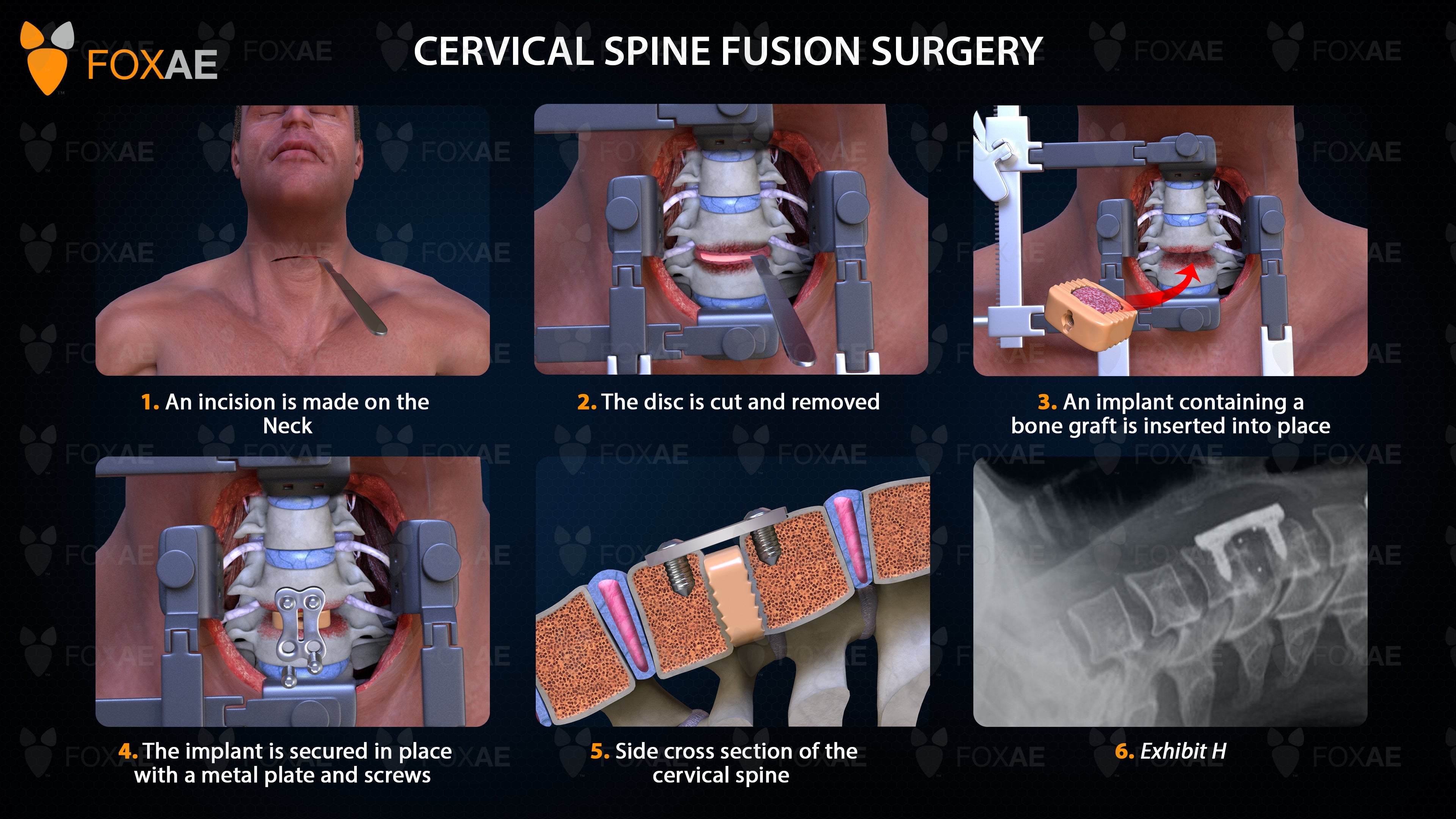 Spinal Surgery – FoxPrime