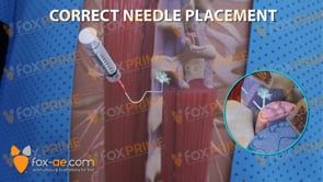 Correct Epidural Anesthesia (Animation) – FoxPrime